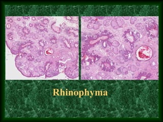 Rhinophyma Histology