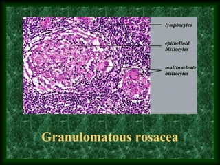 Granulomatous Rosacea Histology