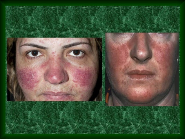 Rosacea
