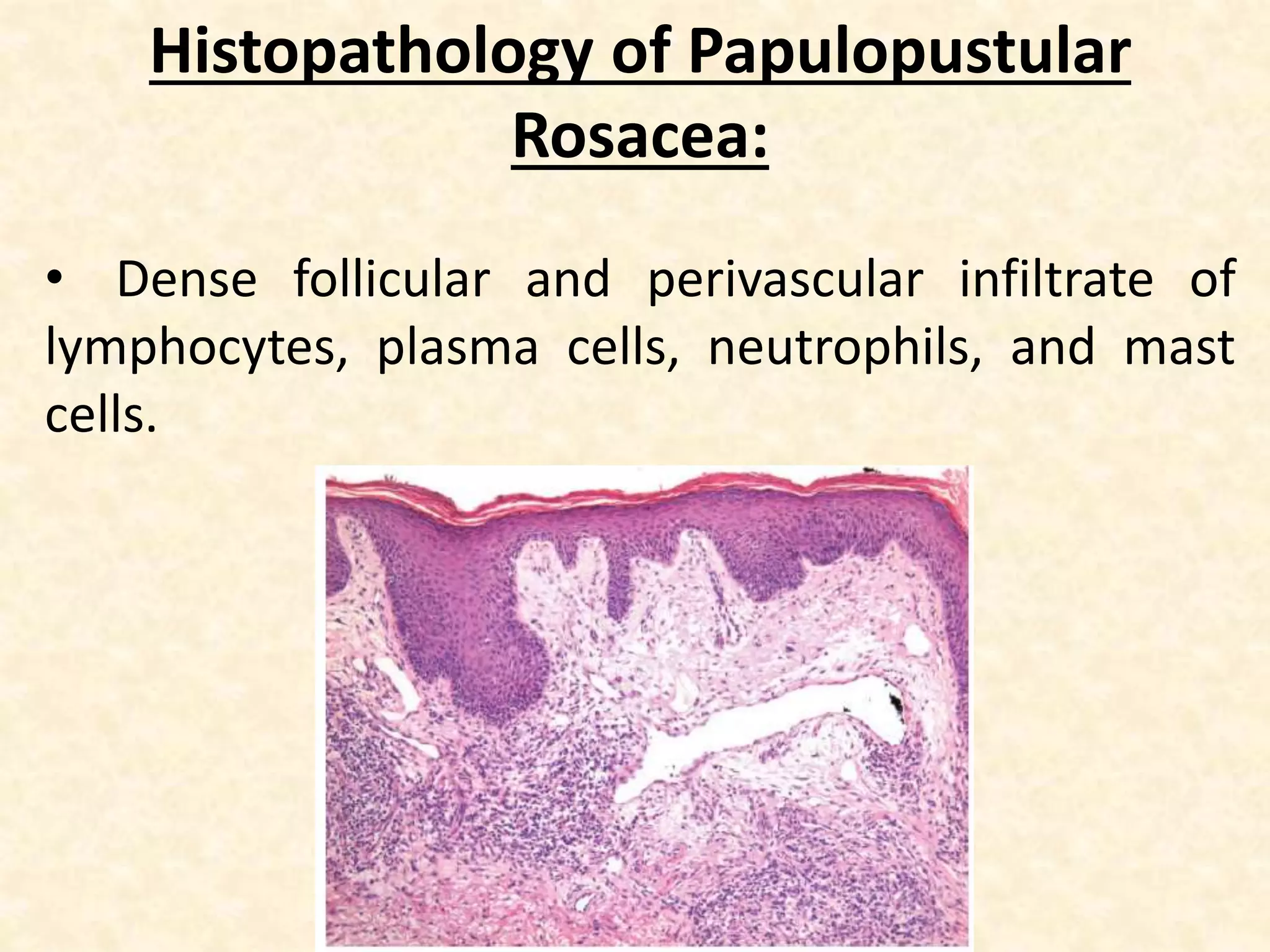 Rosacea: Inflammatory condition in Dermatology | PPTX