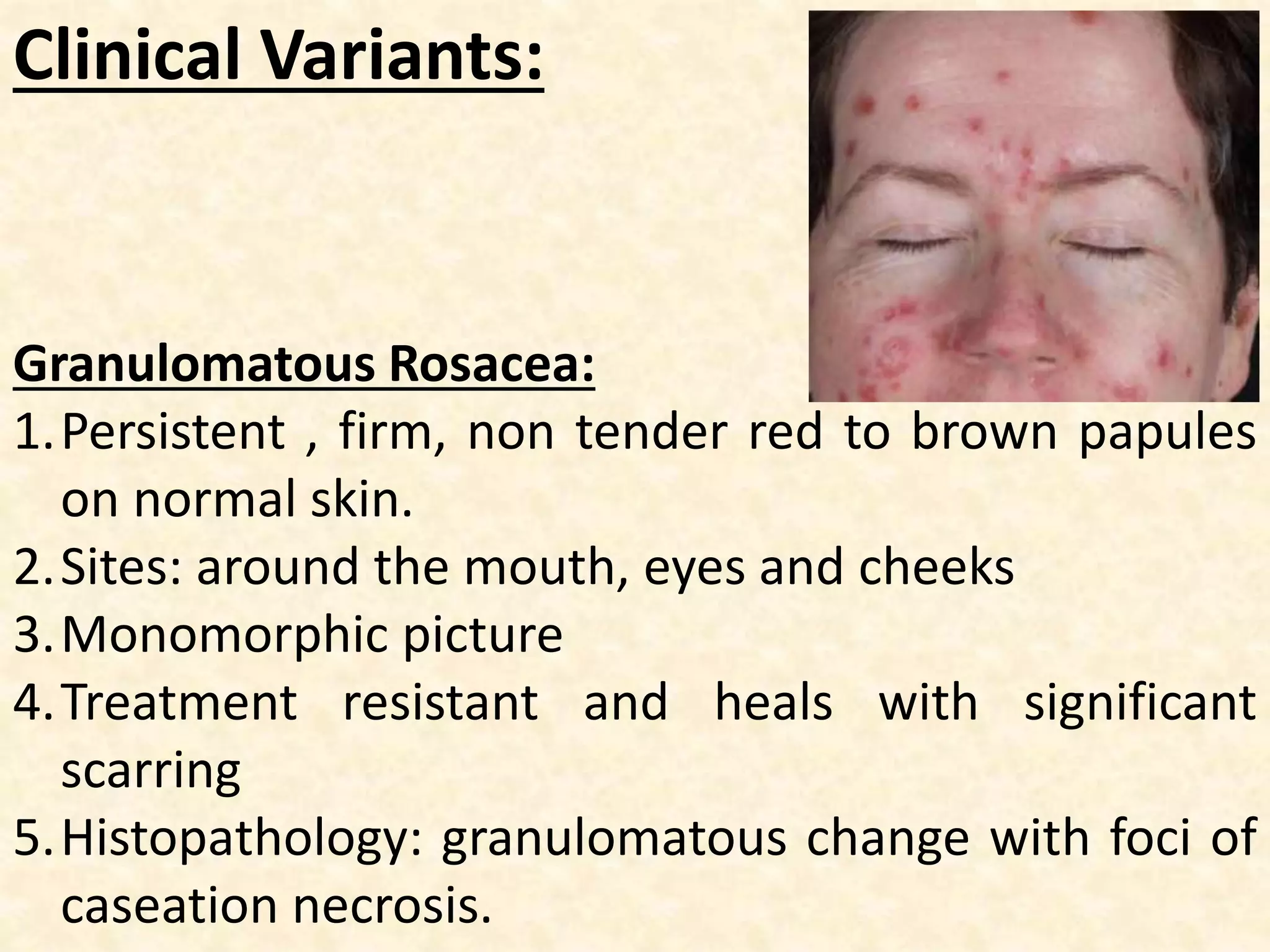 Rosacea: Inflammatory condition in Dermatology | PPTX