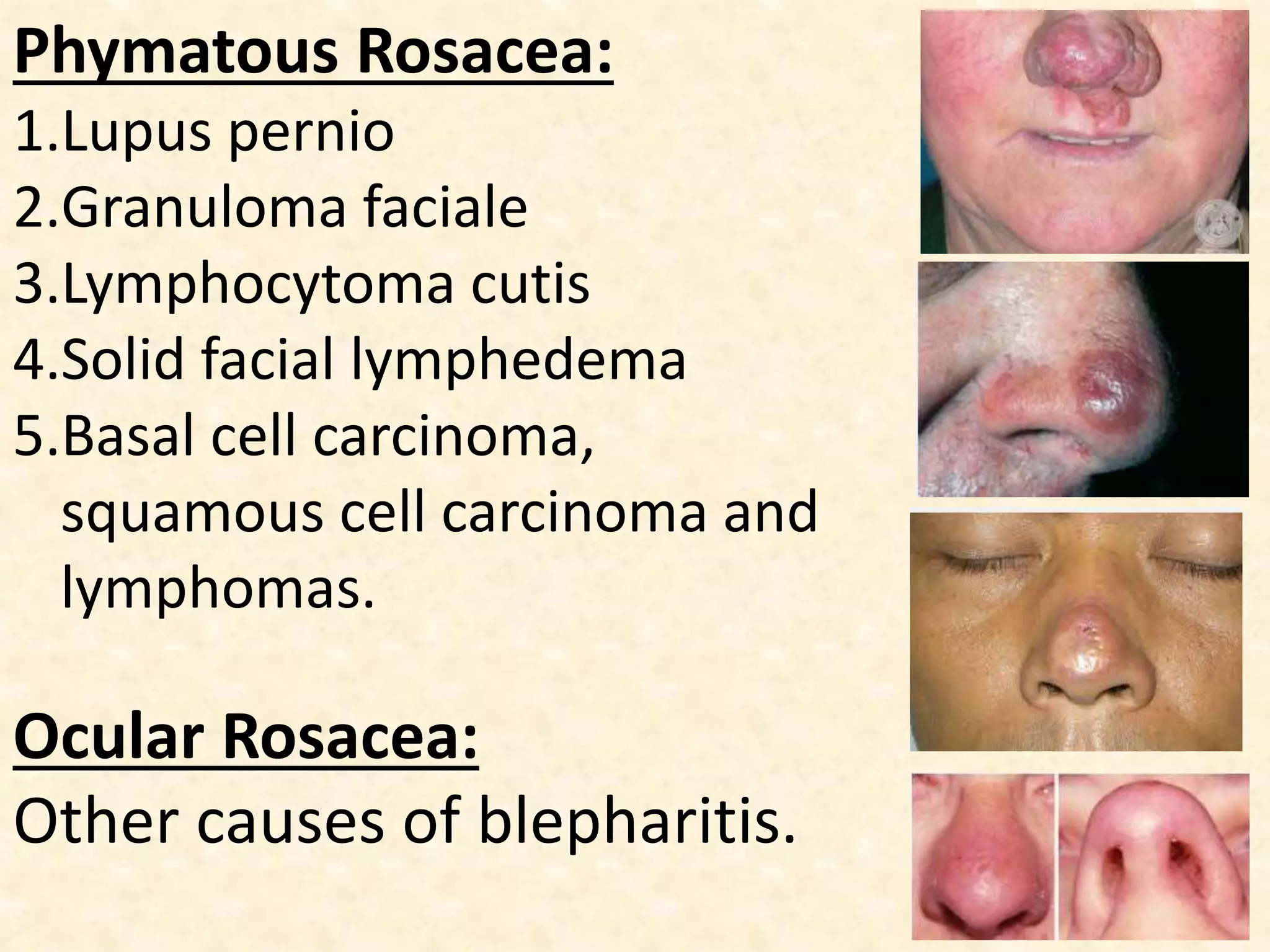 Rosacea: Inflammatory condition in Dermatology | PPTX