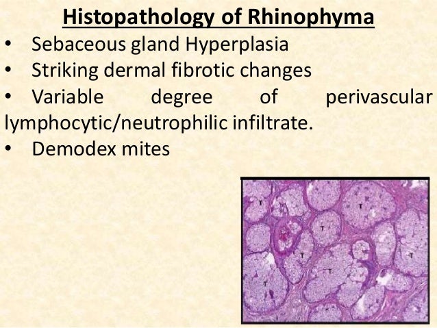 Rhinophyma Histology Phymatous Rosacea Is Uncommon. The Most Frequent