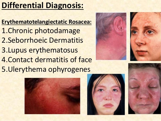 Rosacea: Inflammatory condition in Dermatology