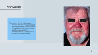 Rosacea | PPTX
