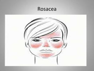 Rosacea presentation | PPTX