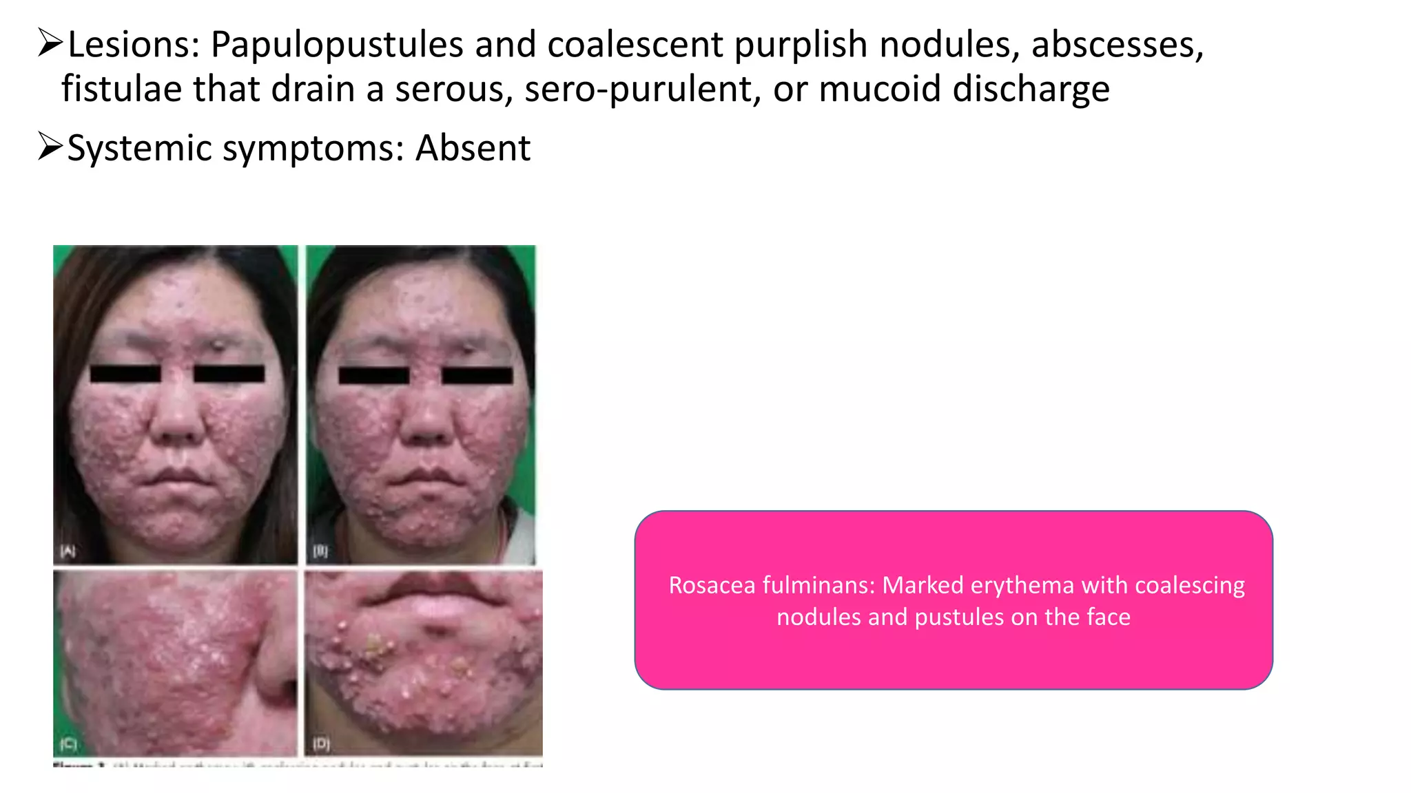 ROSACEA.pptx