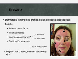 Rosácea y dermatitis perioral | PPTX