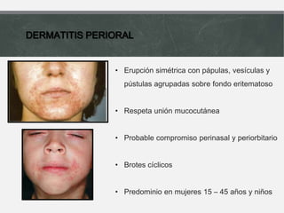 Rosácea y dermatitis perioral | PPTX