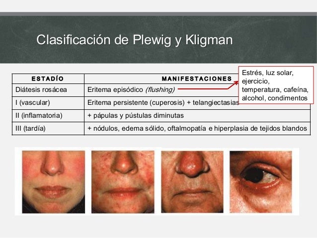 Rosácea y dermatitis perioral