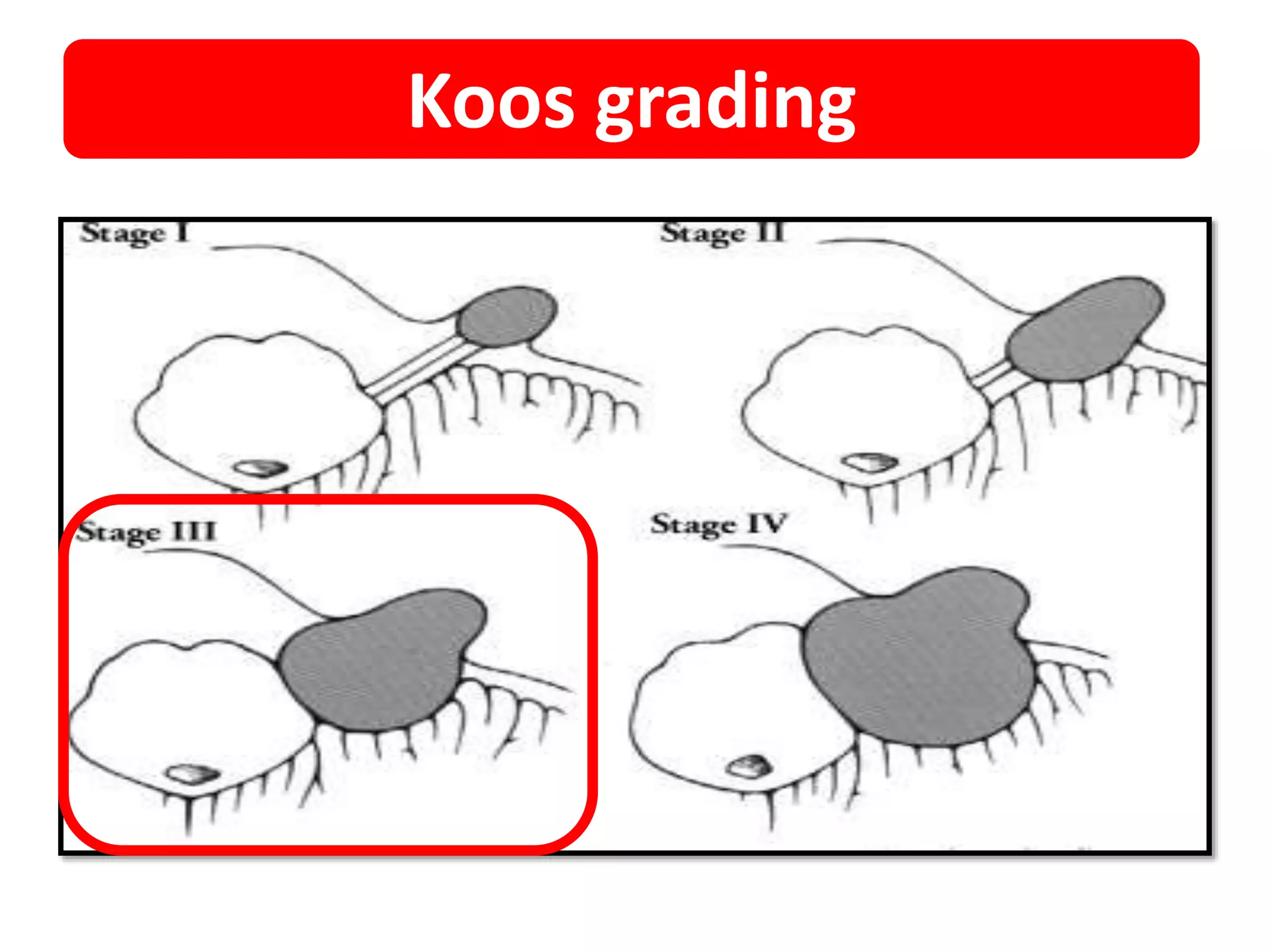 ROSE CASE - STEREOTACTIC RADIOTHERAPY FOR VESTIBULAR SCHWANNOMA | PPTX