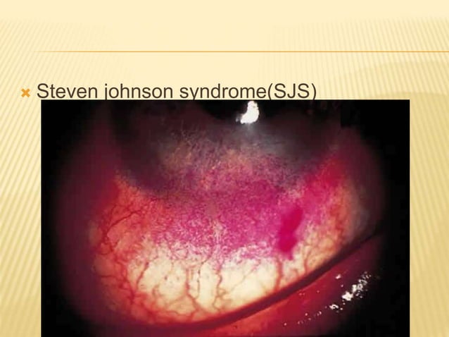 Rose bengal stainining | PPTX | Eye and Vision Conditions | Diseases ...