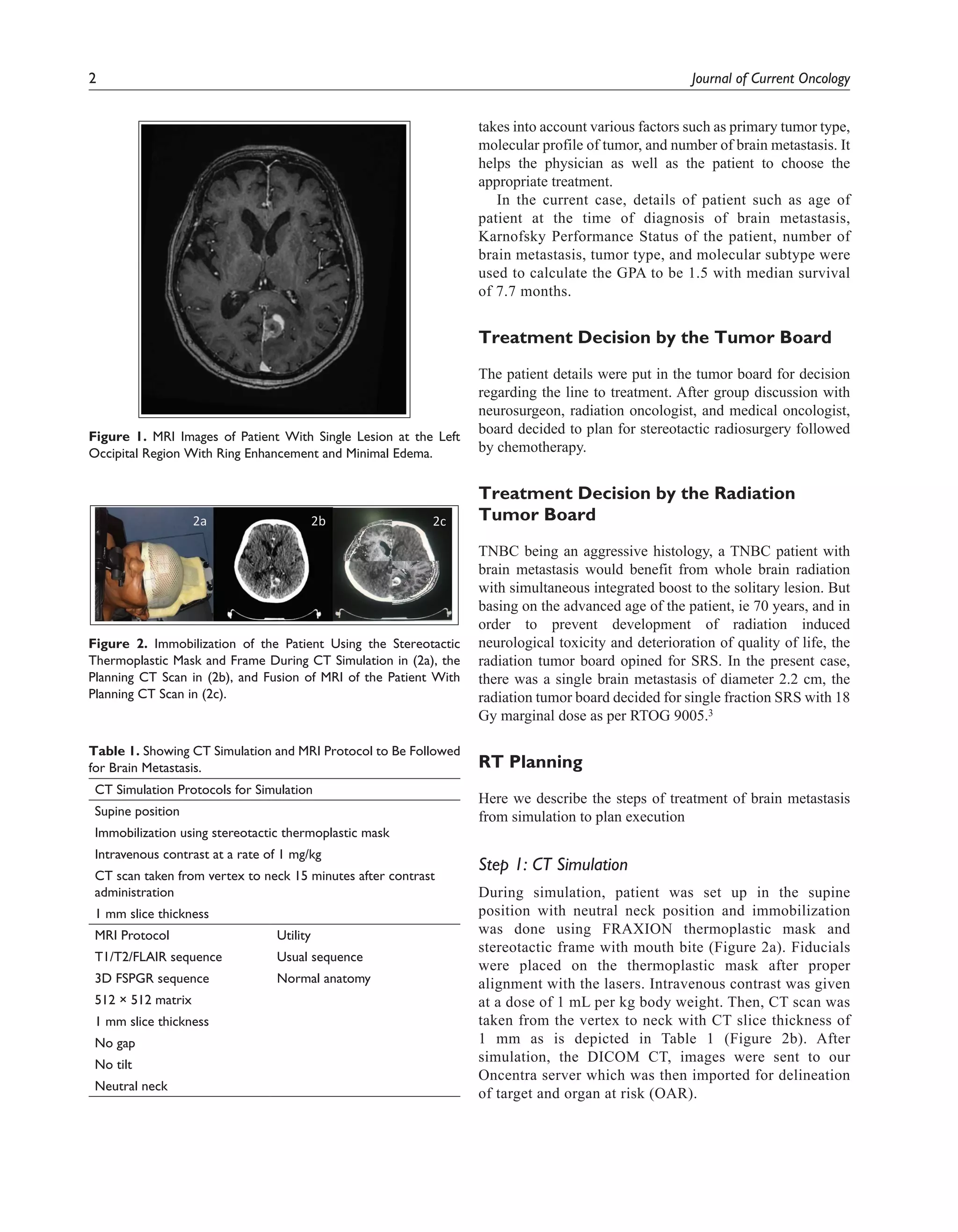 ROSE CASE BRAIN MET SRS | PDF
