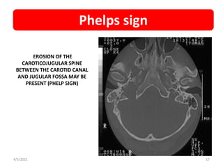 ROSE CASE GLOMUS TUMOR SRS | PPT
