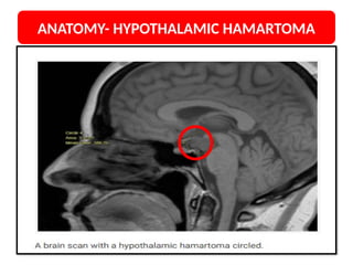 ROSE CASE SRS FOR HYPOTHALAMIC HAMARTOMA BY DR KANHU CHARAN PATRO | PPTX