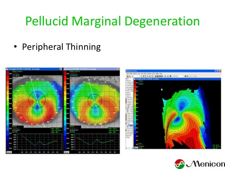 Pellucid Marginal Degeneration Vs Keratoconus