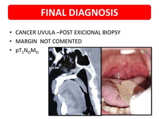 Uvula Cancer