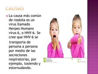 Roseola2 | PPTX