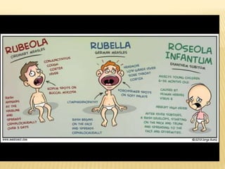 Roseola infantum | PPTX