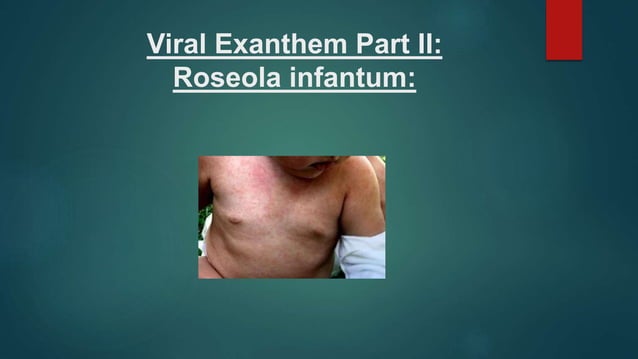 Roseola infantum Made Ridiculously Easy!!! | PPTX