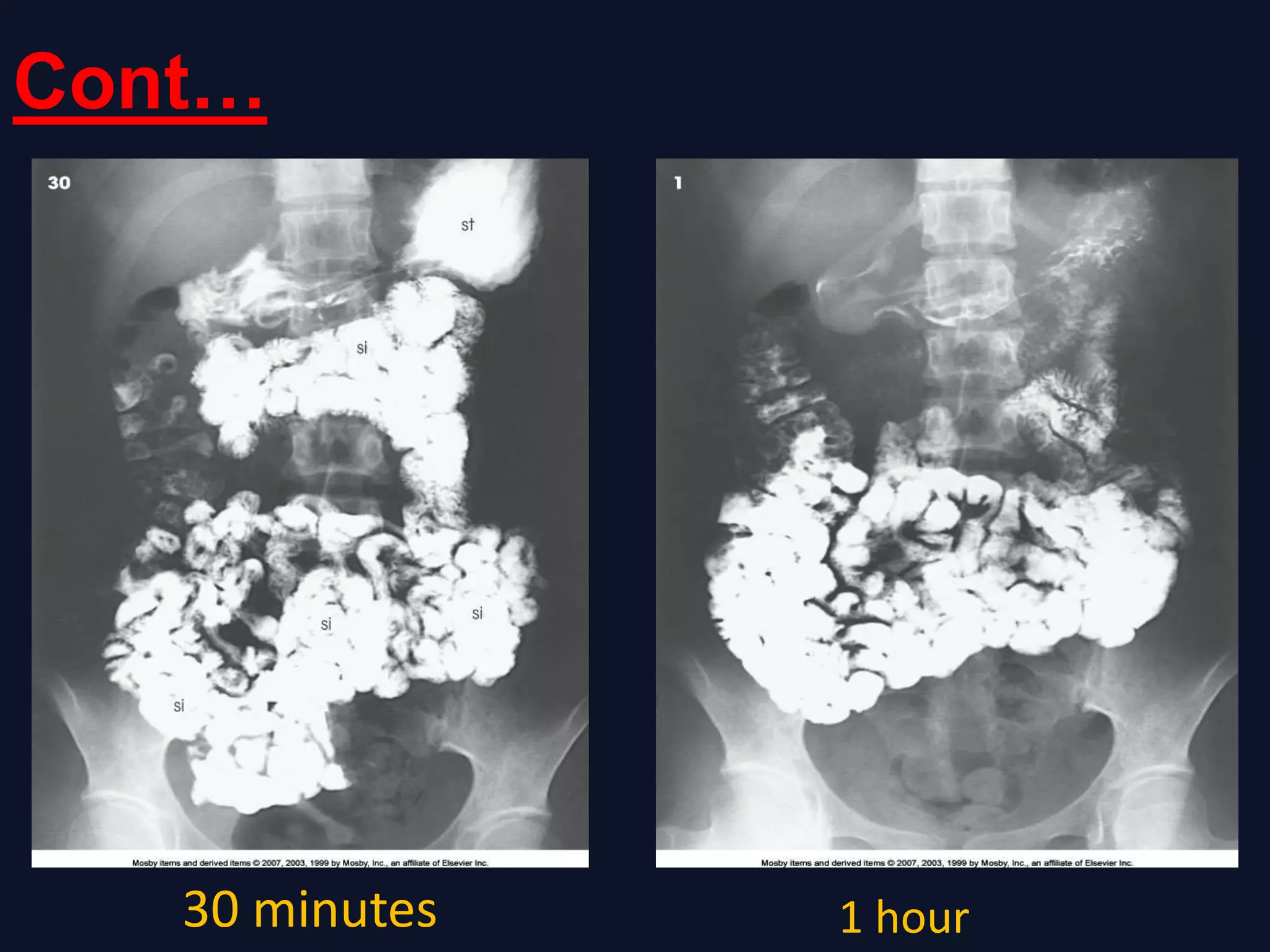 Barium series | PPTX