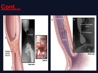 Barium series | PPTX