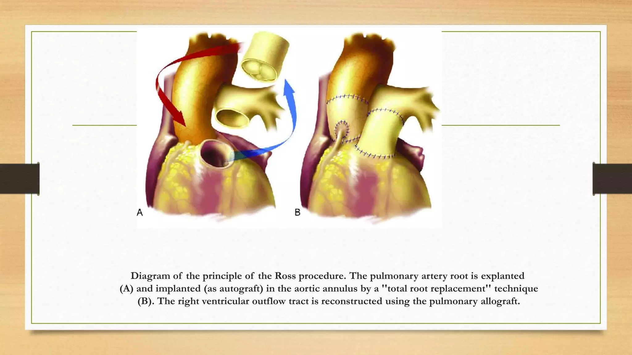 Ross Procedure Pptx
