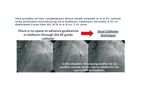 Rotablation | PPTX | Heart and Cardiovascular Diseases | Diseases and ...