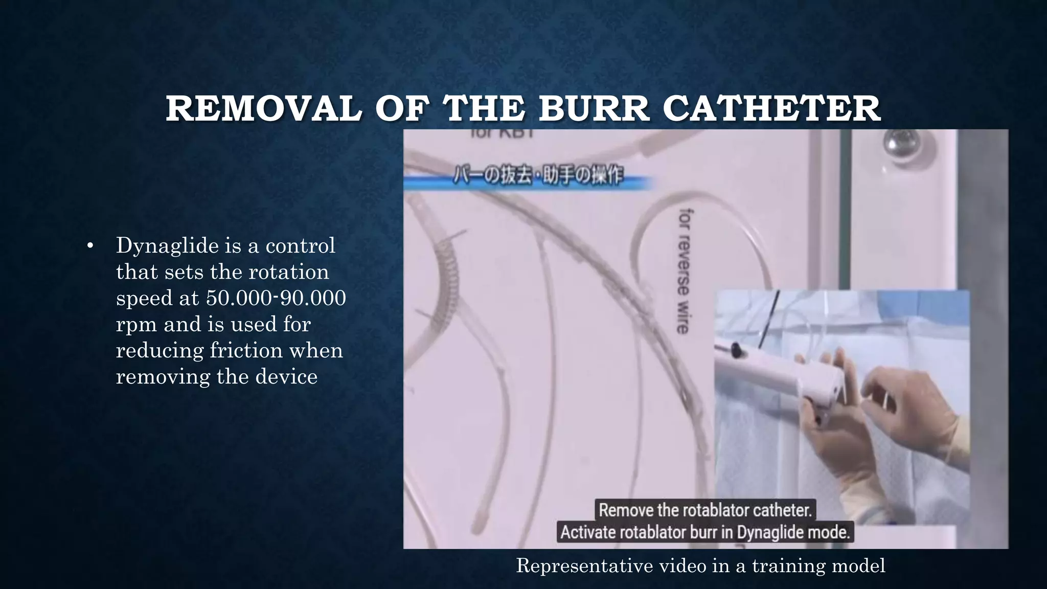 Rotablation - An overview | PPTX
