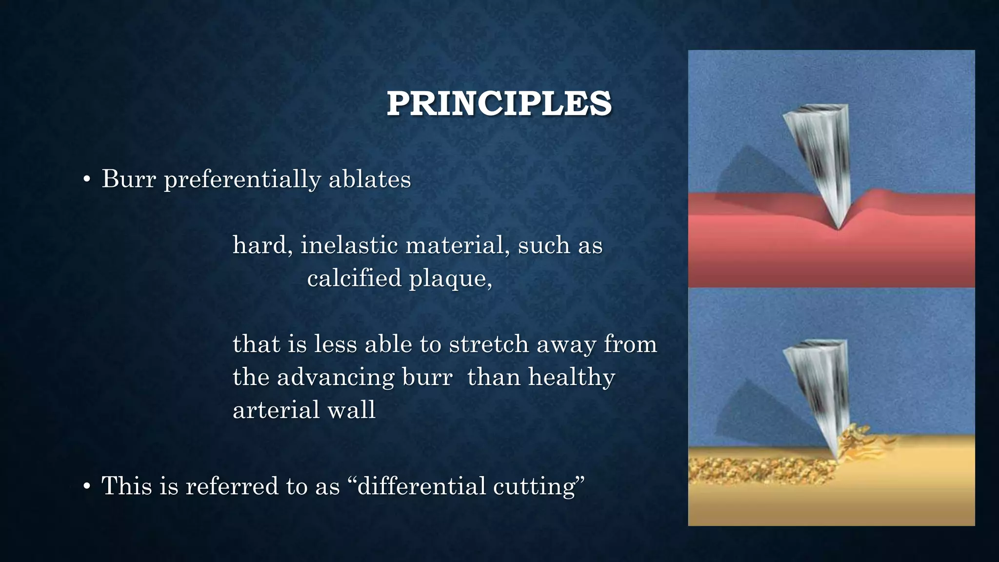 Rotablation - An overview | PPTX