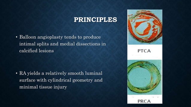 Rotablation - An overview | PPTX
