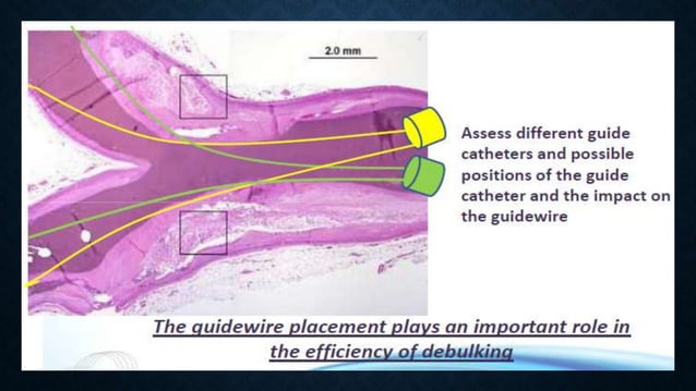 Rotablation - An overview | PPTX