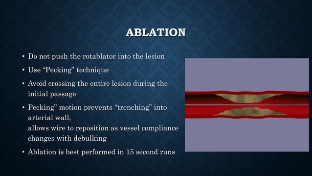 Rotablation - An overview | PPTX