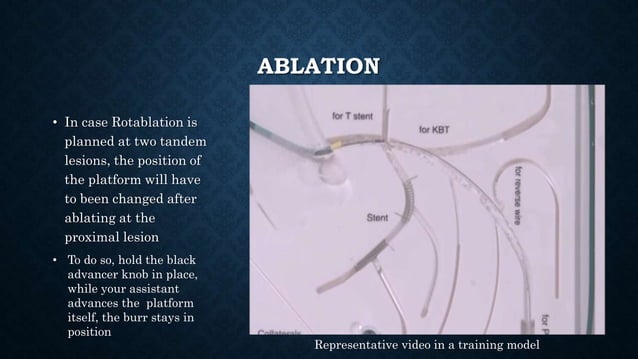 Rotablation - An overview | PPTX