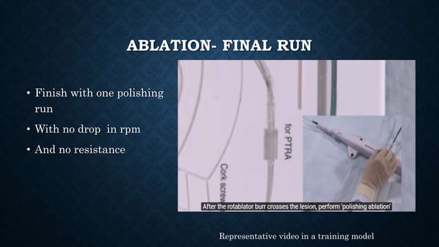 Rotablation - An overview | PPTX