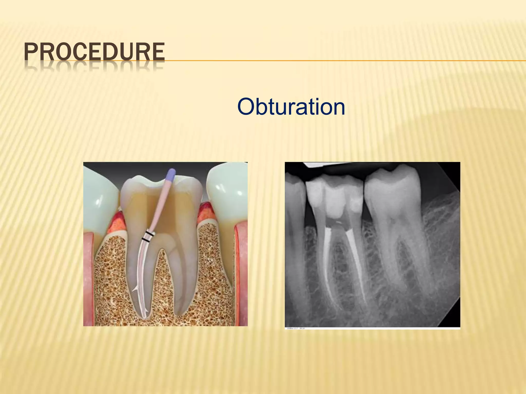 Rotary system in endodontic treatment | PPTX
