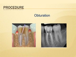 Rotary system in endodontic treatment | PPTX