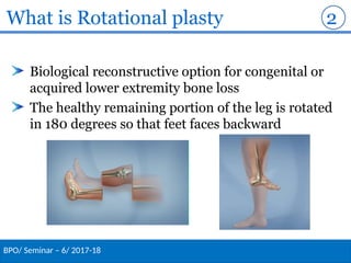 Rotational Plasty - Seminar.ppt for prosthetic and orthotic students | PPT