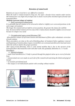 Rotation in orthodontics.docx