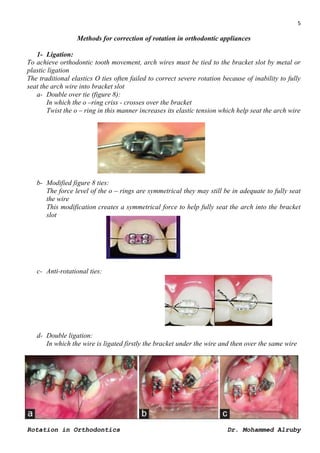 Rotation in orthodontics.docx