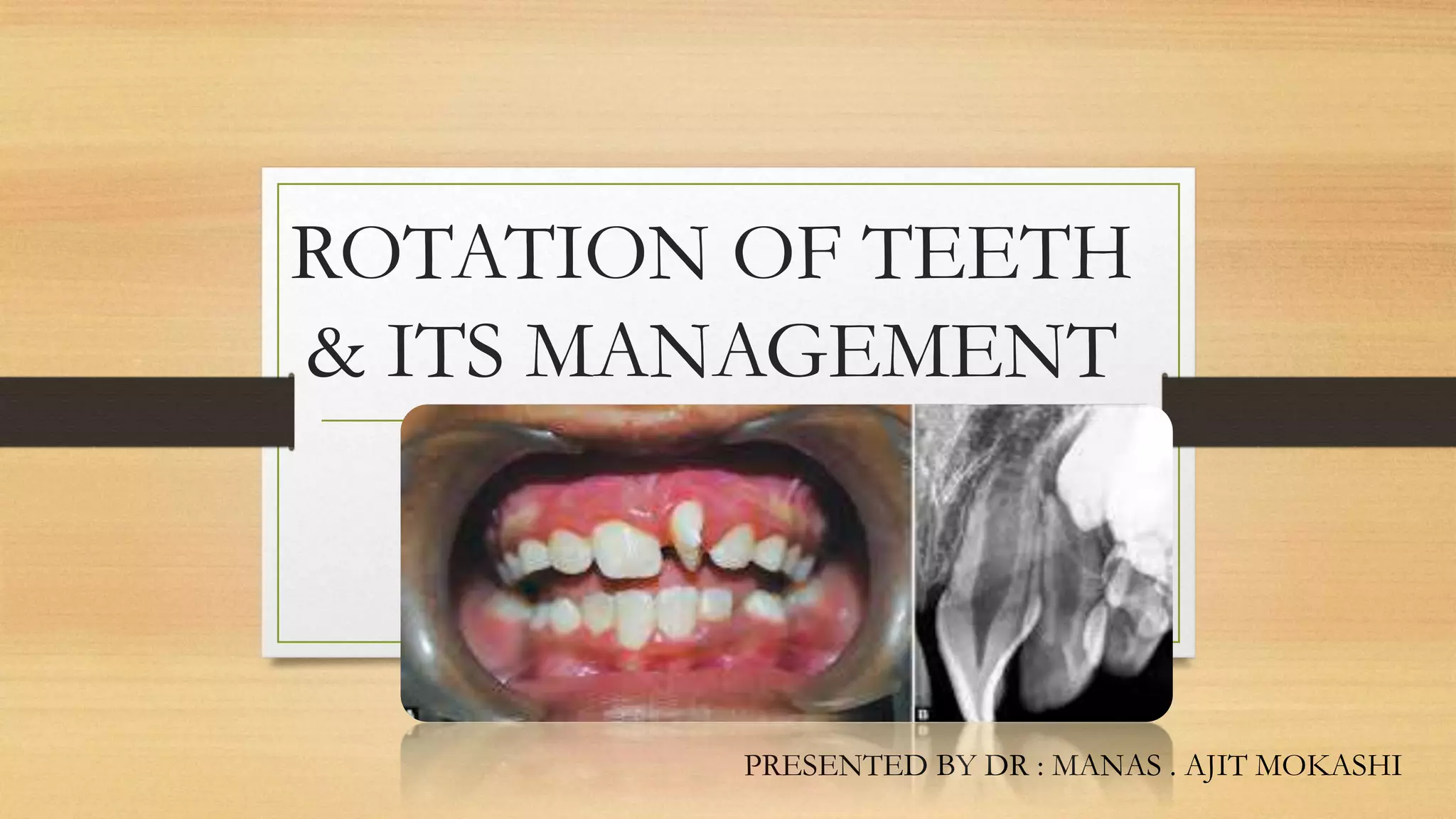 Rotation of teeth & its management | PPTX