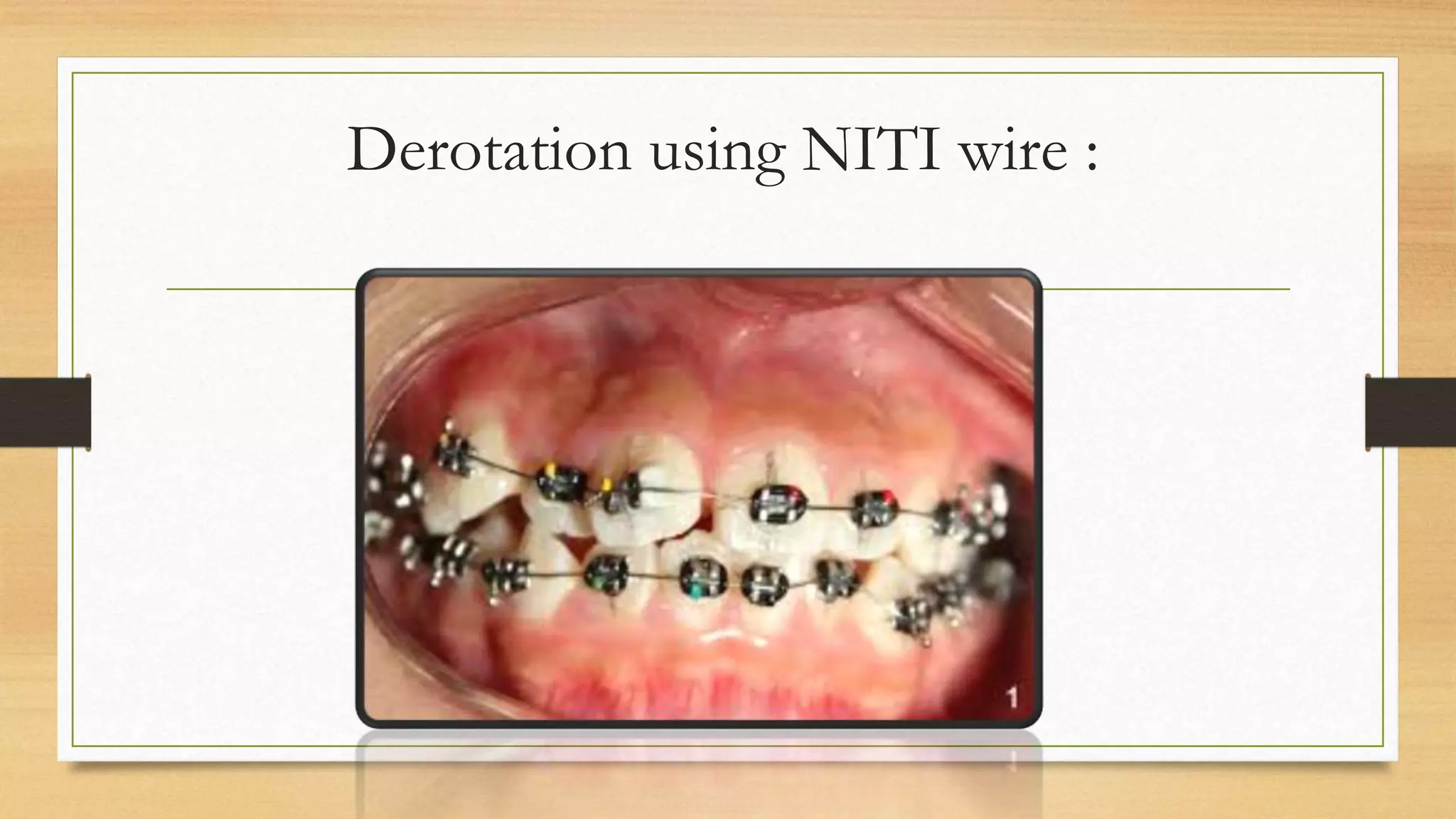 Rotation of teeth & its management | PPTX