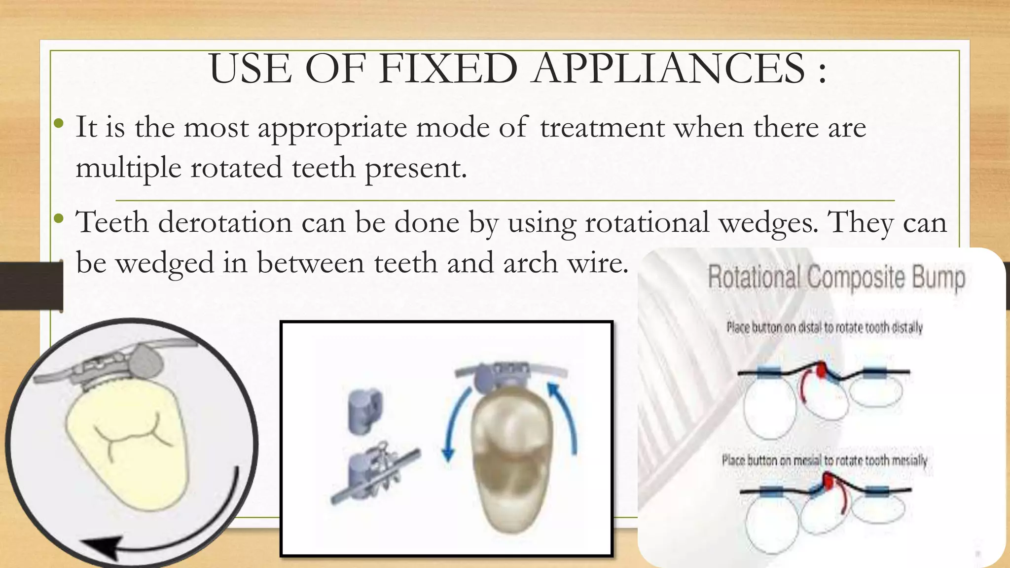 Rotation of teeth & its management | PPTX