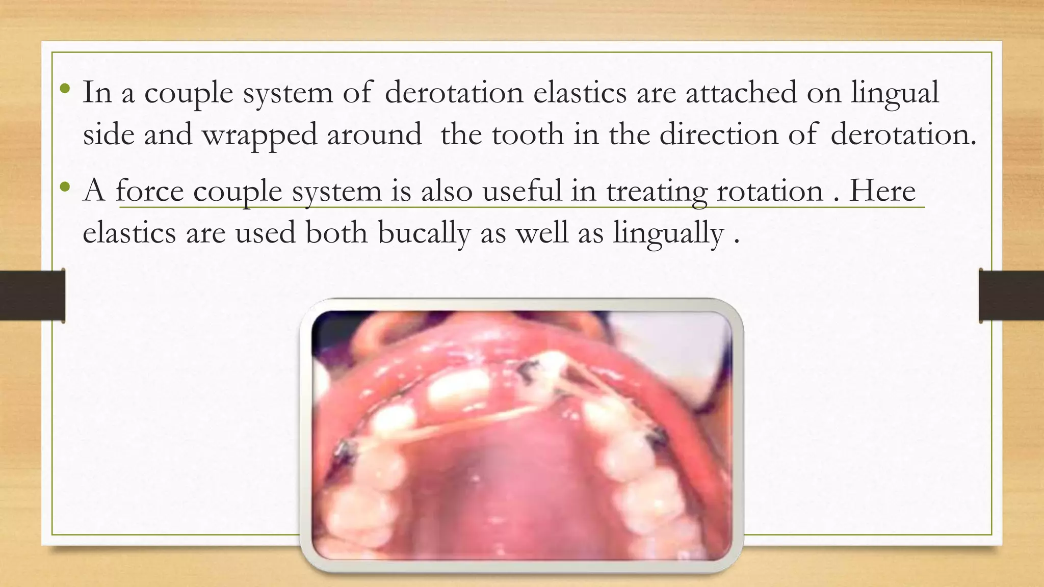 Rotation of teeth & its management | PPTX