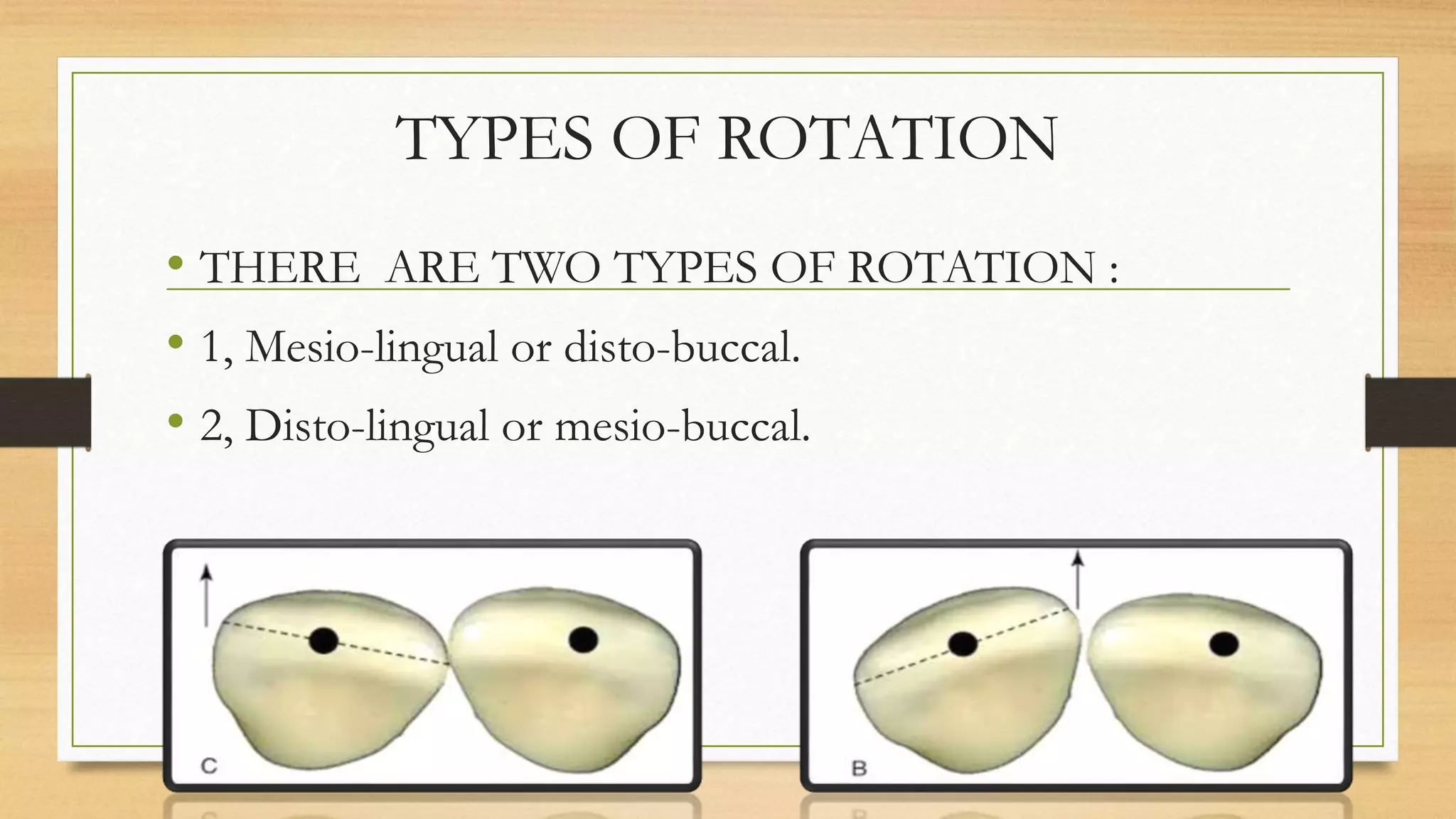 Rotation of teeth & its management | PPTX