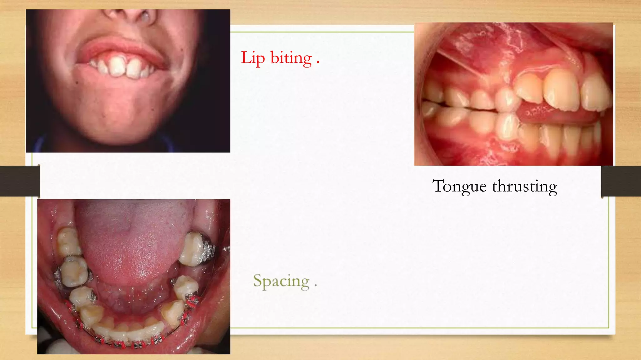Rotation of teeth & its management | PPTX