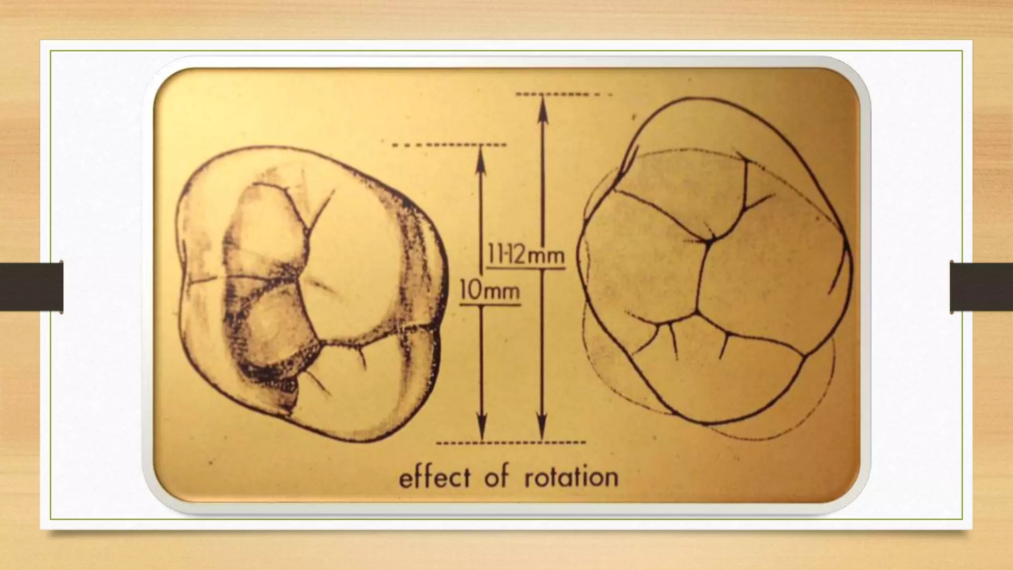 Rotation of teeth & its management | PPTX