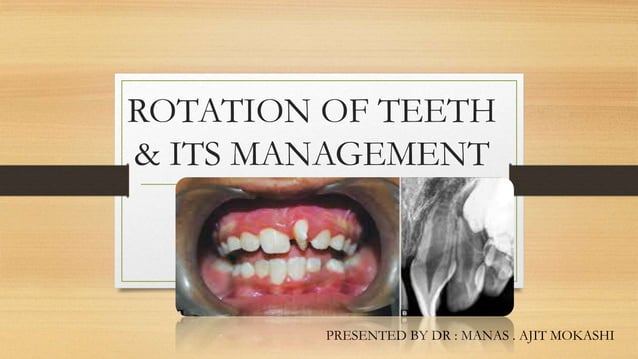 Rotation of teeth & its management | PPTX | Oral care | Personal Care