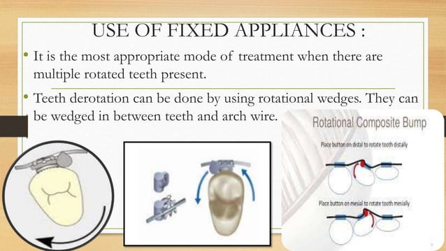 Rotation of teeth & its management | PPTX | Oral care | Personal Care