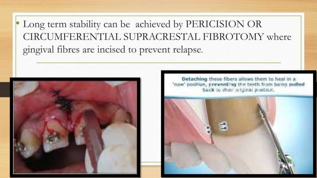 Rotation of teeth & its management | PPTX | Oral care | Personal Care